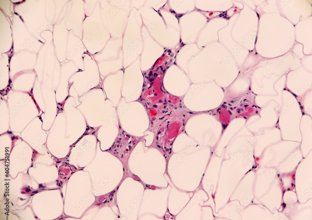 Angiolipoma. A benign tumor composed of white fat cells and multiple ...
