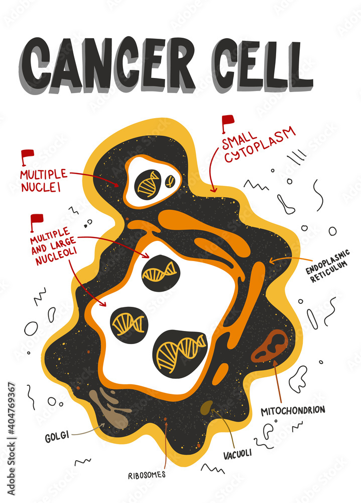 Cancer cells structure. Labeled Cancer cell anatomy. characteristic of ... Cancer cells structure. Labeled Cancer cell anatomy. characteristic of ...