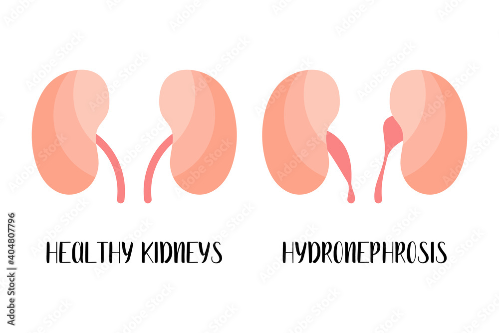 Hydronephrosis and healthy kidneys. Urology. Diagnosis of kidney ...