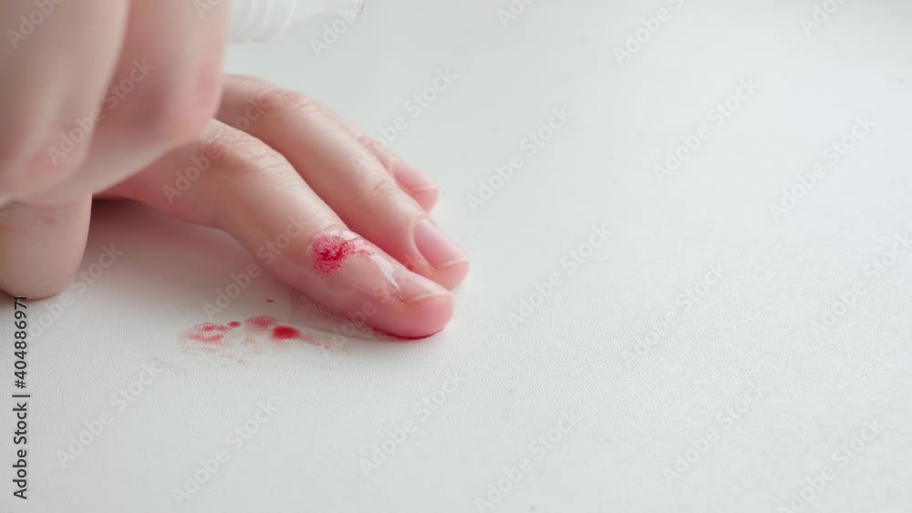 Hydrogen peroxide is poured on a bleeding cut of the middle finger of a ...