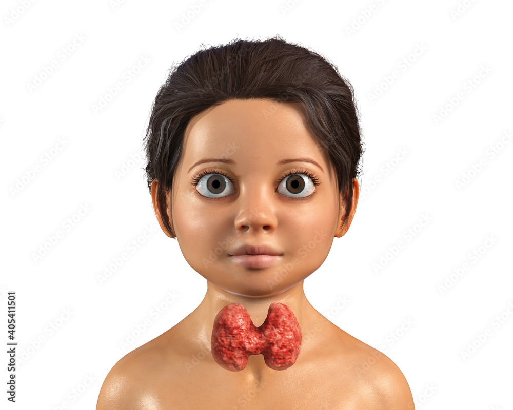 Hyperthyroidism in children, Pediatric thyrotoxicosis Stock ...