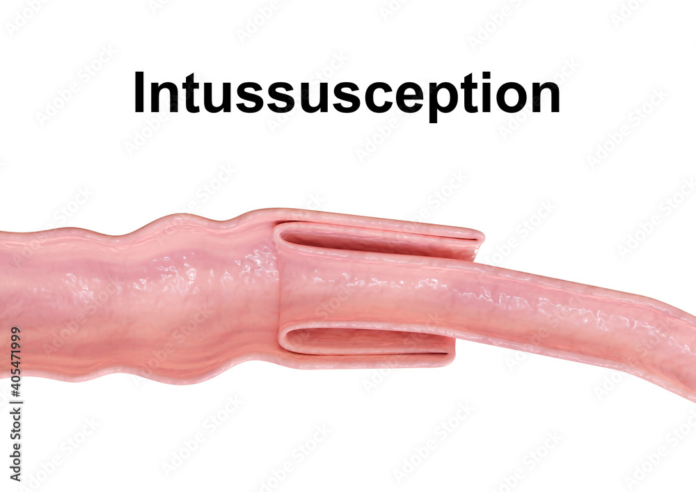 Intussusception is a disorder that causes obstruction of the intestine ...