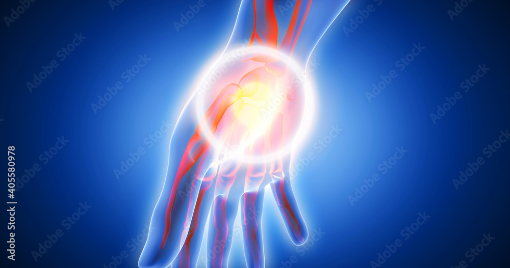 Pain in the arm, pain in the fingers, human skeleton, bone scan, joint ...
