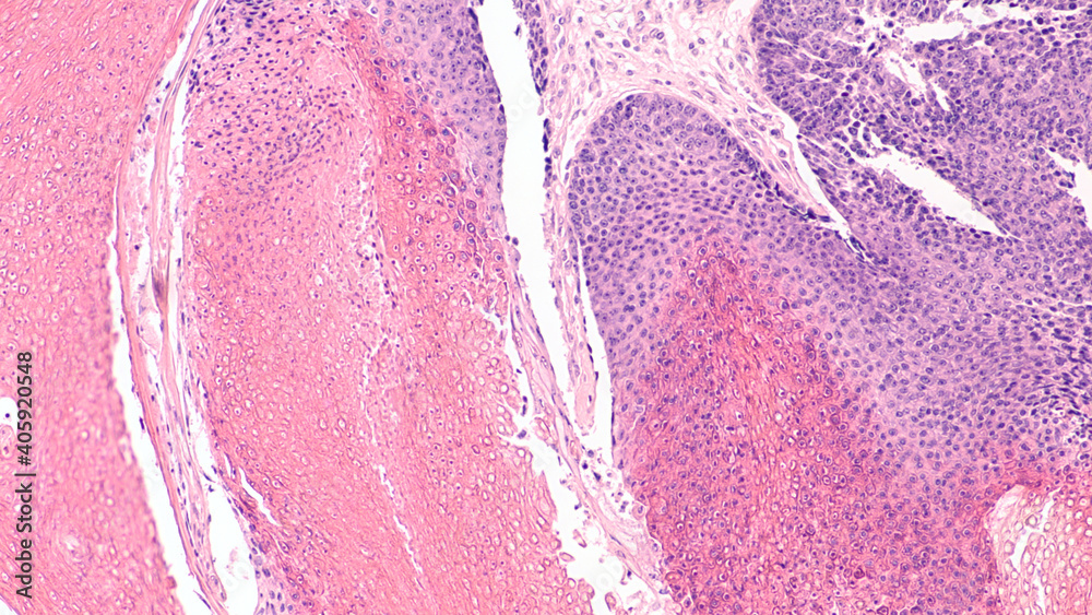 Photomicrograph of a pilomatrixoma, also known as "calcifying ...
