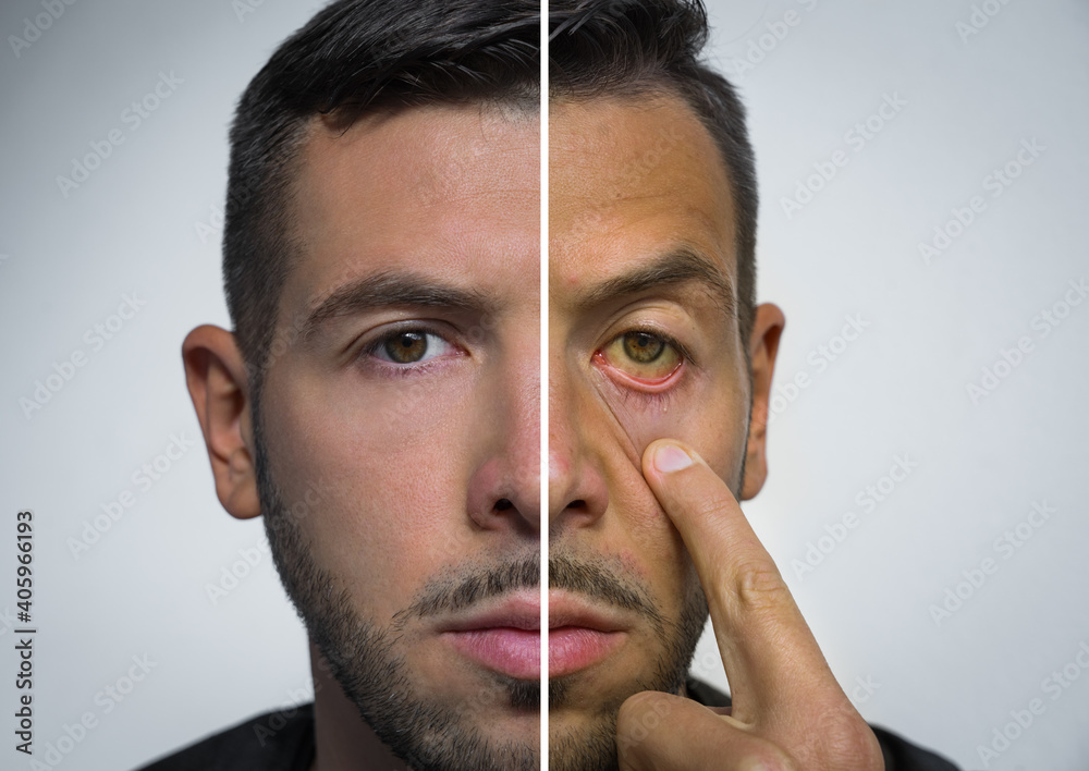Man face divided into two parts one healthy and one unhealthy. Bad ...