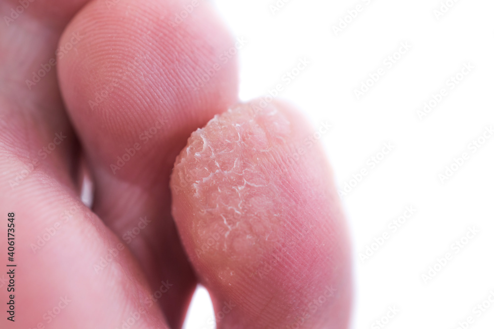 A case of verruca or plantar warts on the bottom of the small toe. A ...