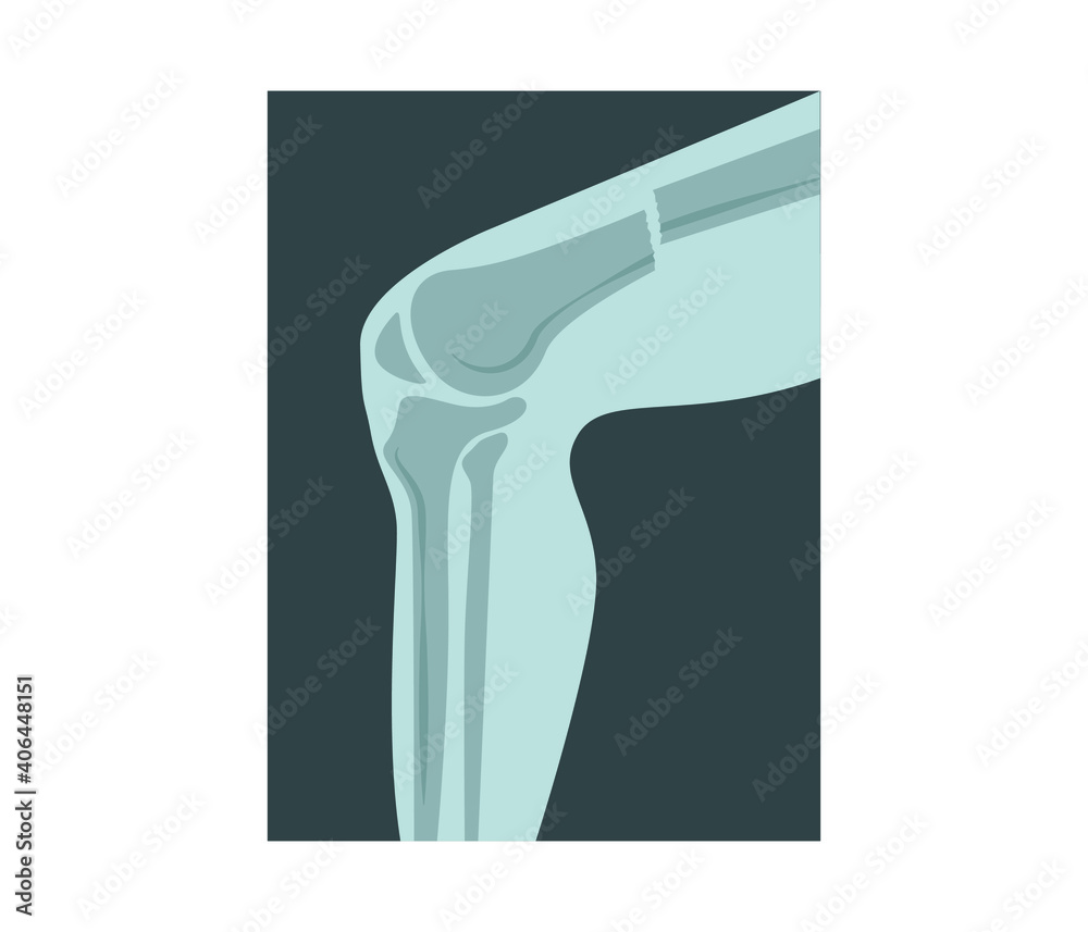 Knee joint human knee replacement x-ray view. Stock Vector | Adobe Stock
