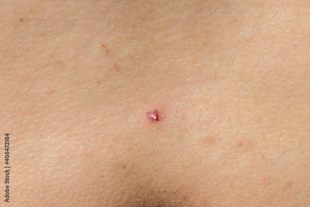 photo of nodular cystic acne skin. Chronic acne skin on woman surface ...