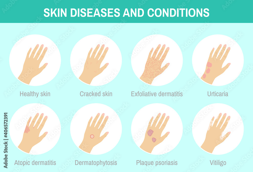 Vector illustration "Skin diseases and conditions". 8 circle images set ...