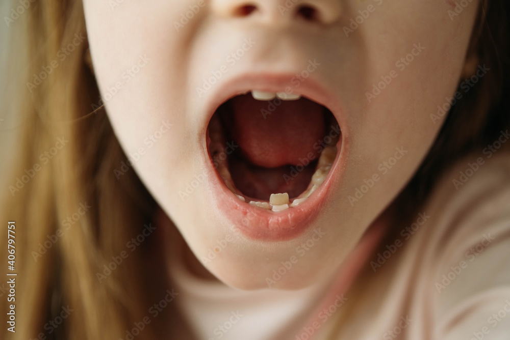 Adult permanent teeth coming in front of the child's baby teeth: shark ...