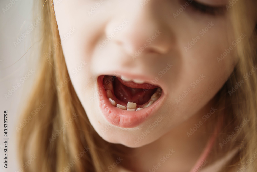 Adult permanent teeth coming in front of the child's baby teeth: shark ...