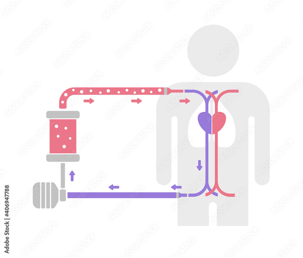 ECMO ( Extracorporeal membrane oxygenation ) structure vector ...