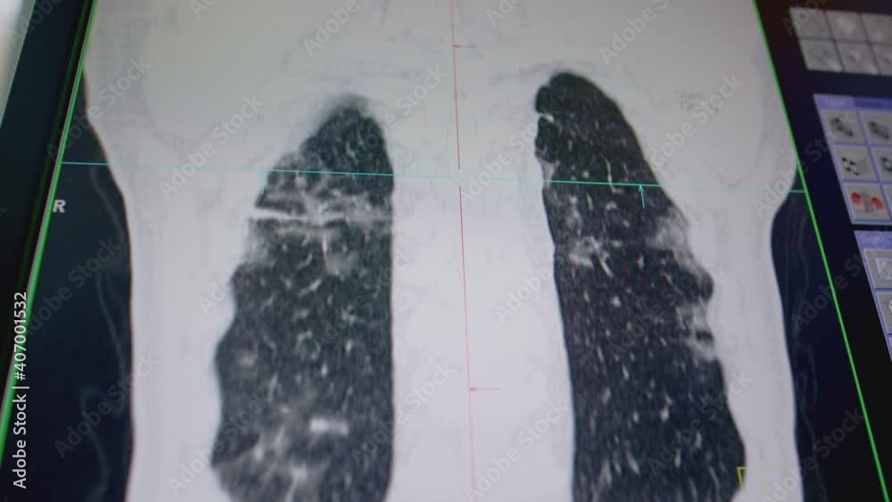 Vidéo Stock The result of a scan of the lungs on a computed tomograph. Lung model on a computer ...