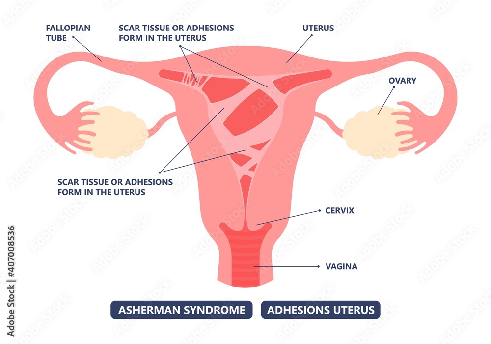 Asherman s Uterus Scar Tissue Cervix Wall Pelvic Pain Trauma And asherman-s-uterus-scar-tissue-cervix-wall-pelvic-pain-trauma-and