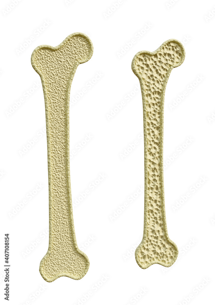 Femur bone cut in half showing normal bone density and osteoporosis ...