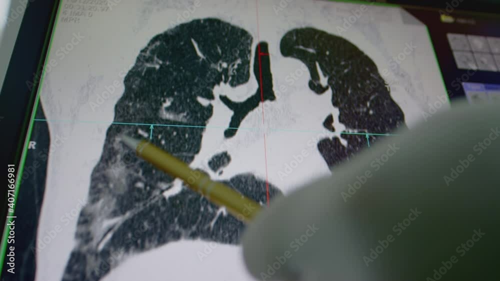 Video Stock The result of a scan of the lungs on a computed tomograph. Lung model on a computer ...