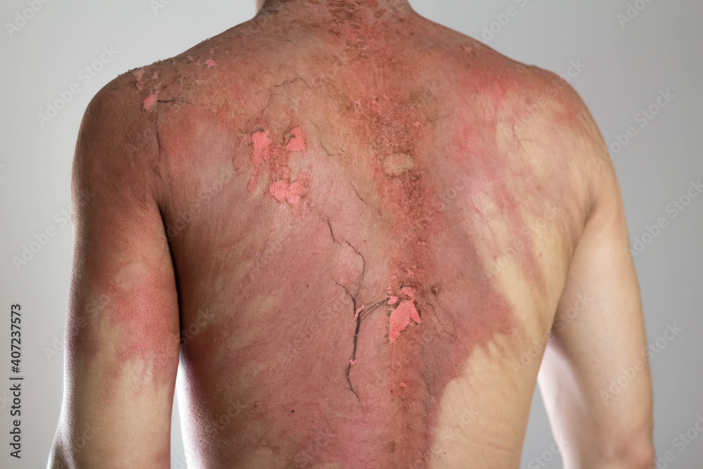 Man with a severe burn all over his body. Close up. Isolated on a gray ...
