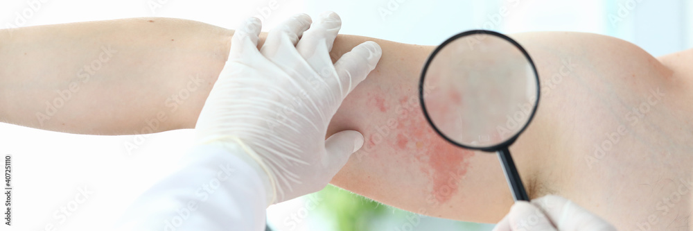 The doctor examines the patients leg with a magnifier. Dermatologist ...