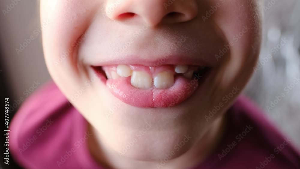 kid, child of 8 shows his teeth, tongue, concept of speech disorders ...