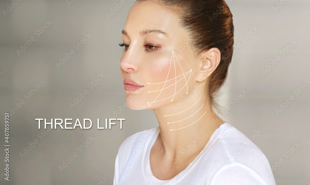 Thread Lift ,markup, thread-lift procedure for facial rejuvenation ...
