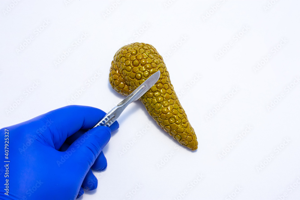 Surgery of pancreas and its ducts on example of figure of organ and ...