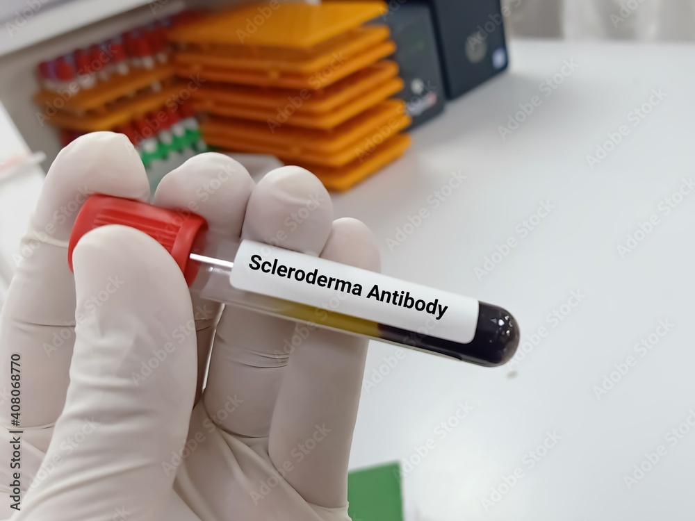Blood sample for Scleroderma. Diagnosis of autoimmune disease, CREST ...