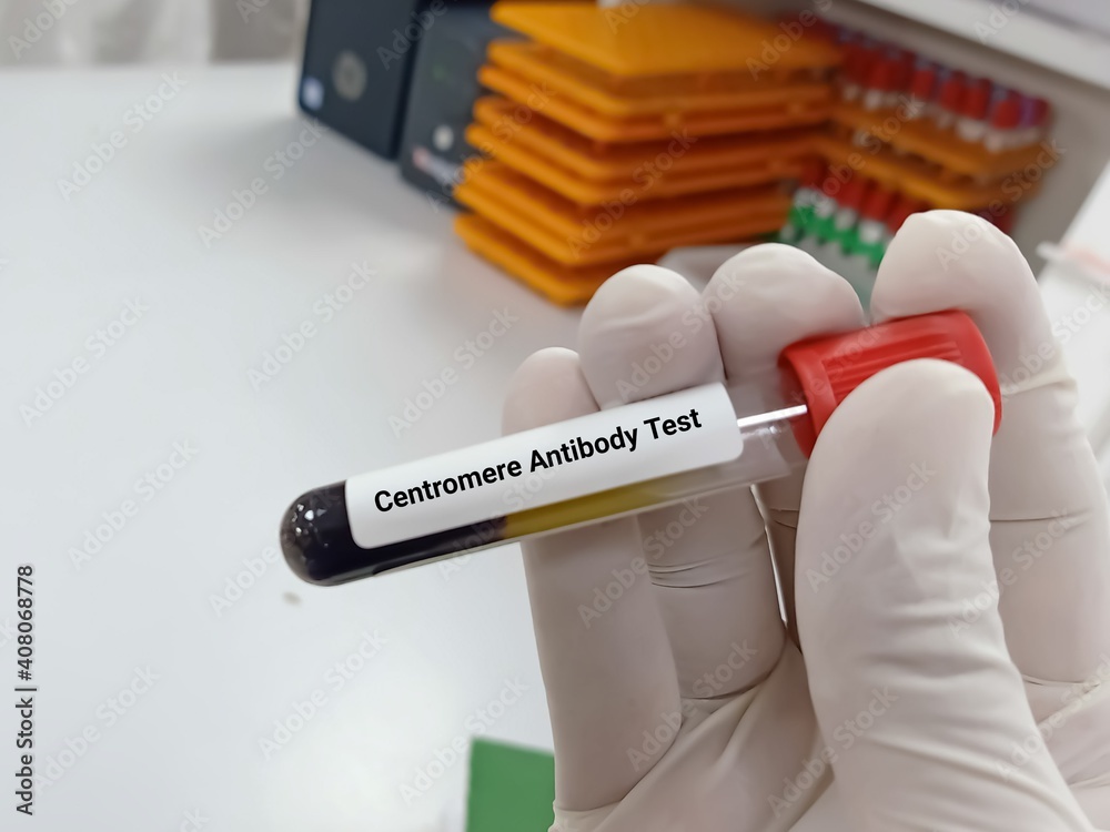 Biochemist or Lab Technologist holds Blood samples for Centromere ...