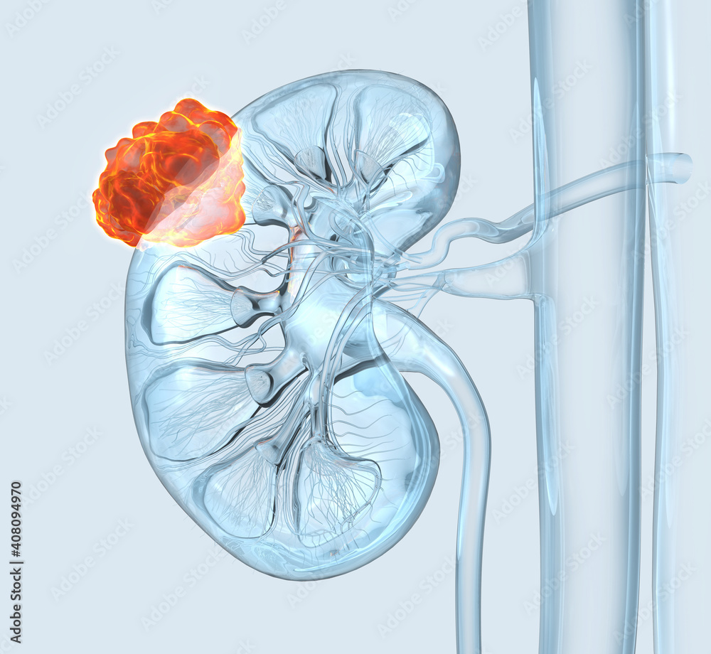 Kidney cancer, human kidney cross section, x-ray style, medical 3D ...