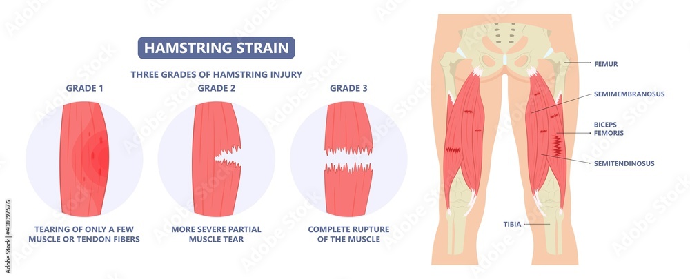 Muscle Strain Grades