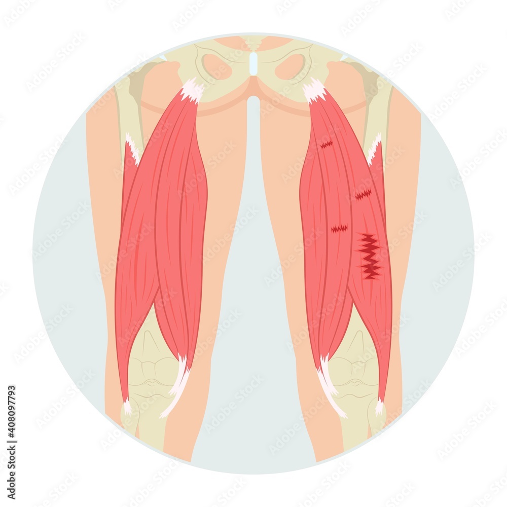 muscle leg knee biceps hip pulled tear injury grade pain running thigh ...
