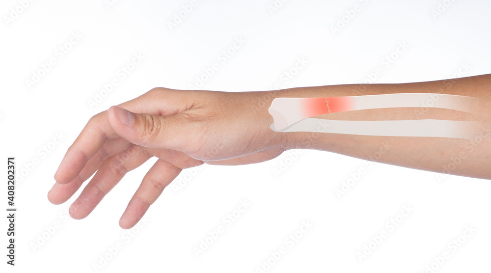 broken forearm bone feel pain and injury Stock Photo | Adobe Stock