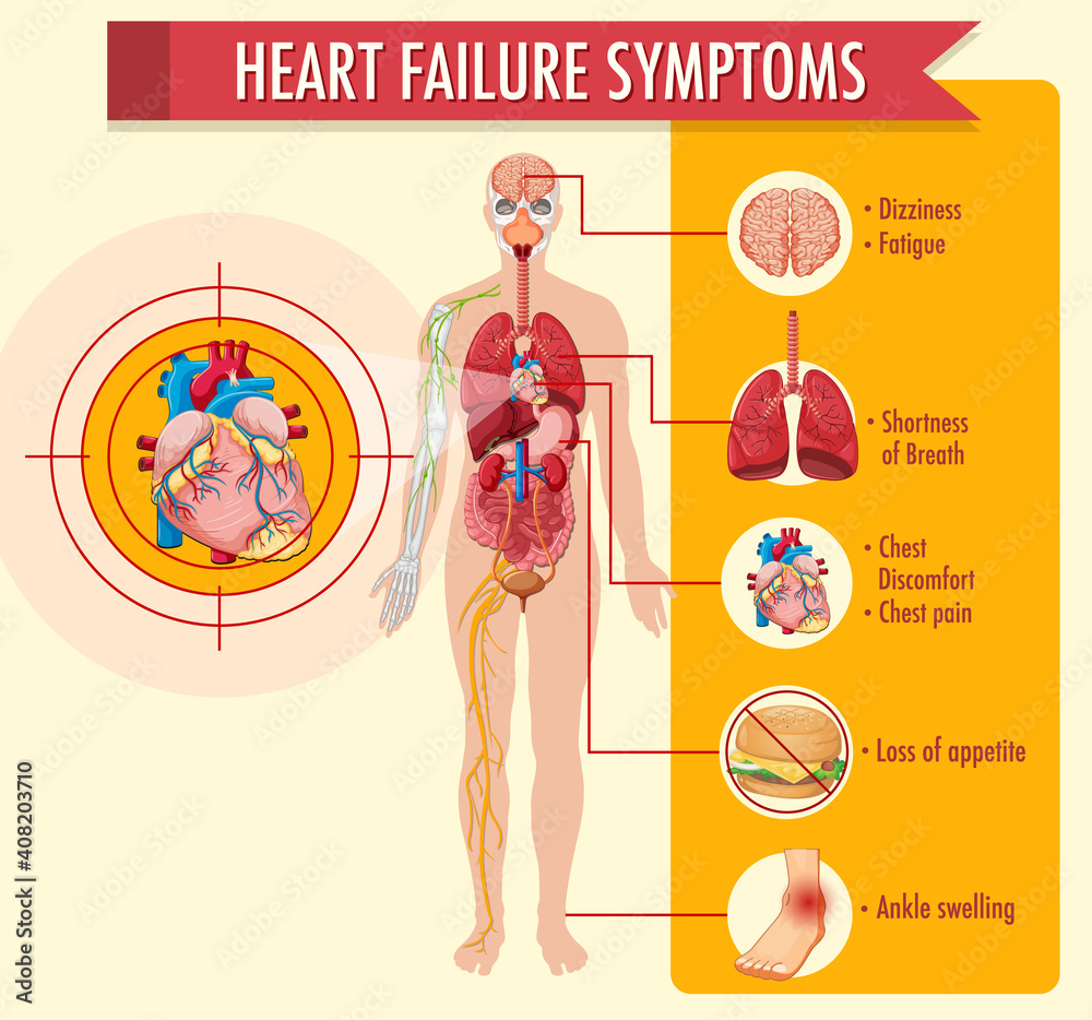 Heart failure symptoms information infographic Stock Vector | Adobe Stock