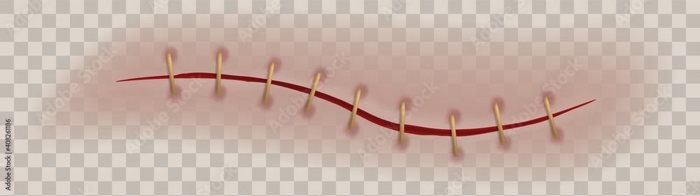 Realistic scar or wound. Bloody surgical sutures healing stitch ...