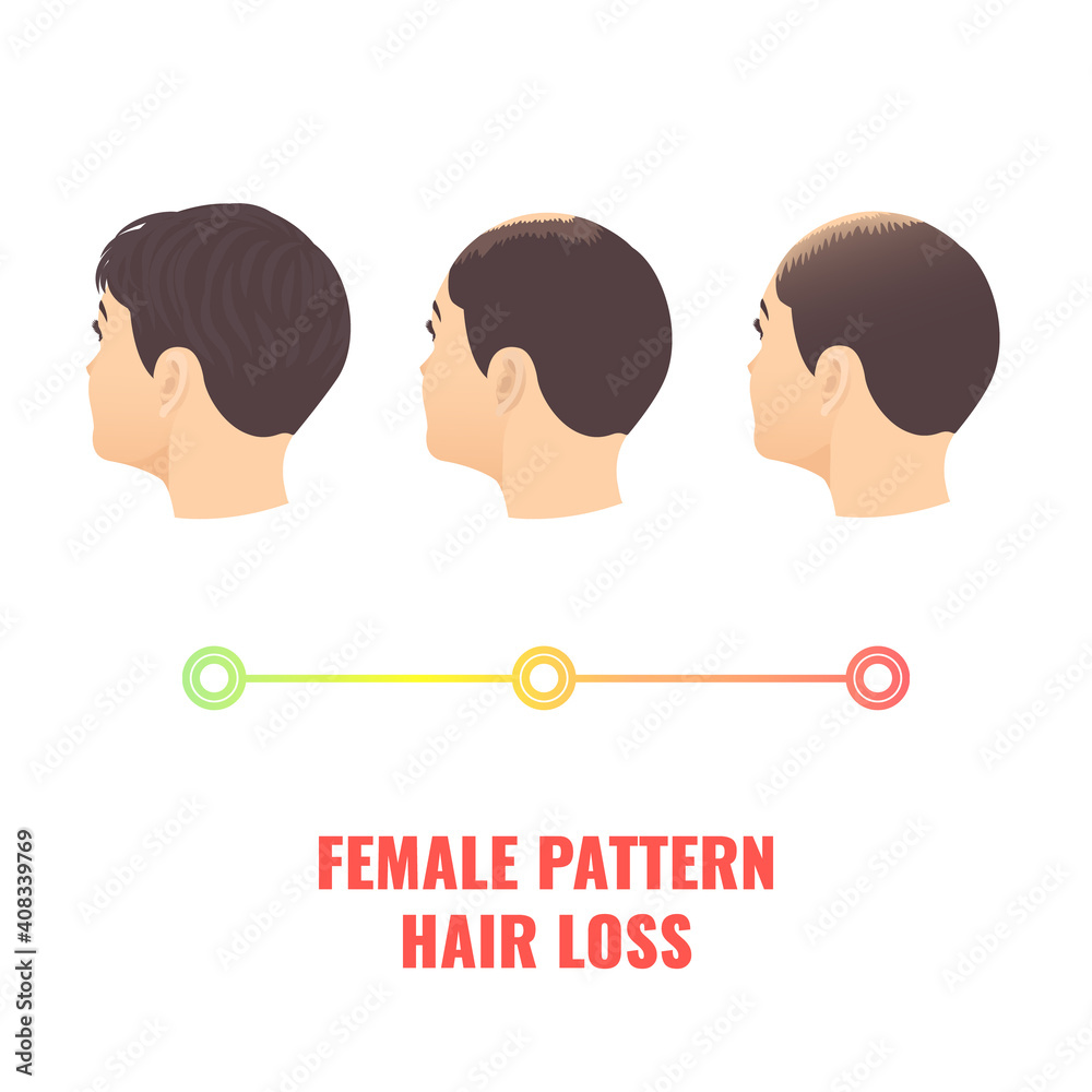 Female-pattern hair loss 3 stages set with head in side view ...