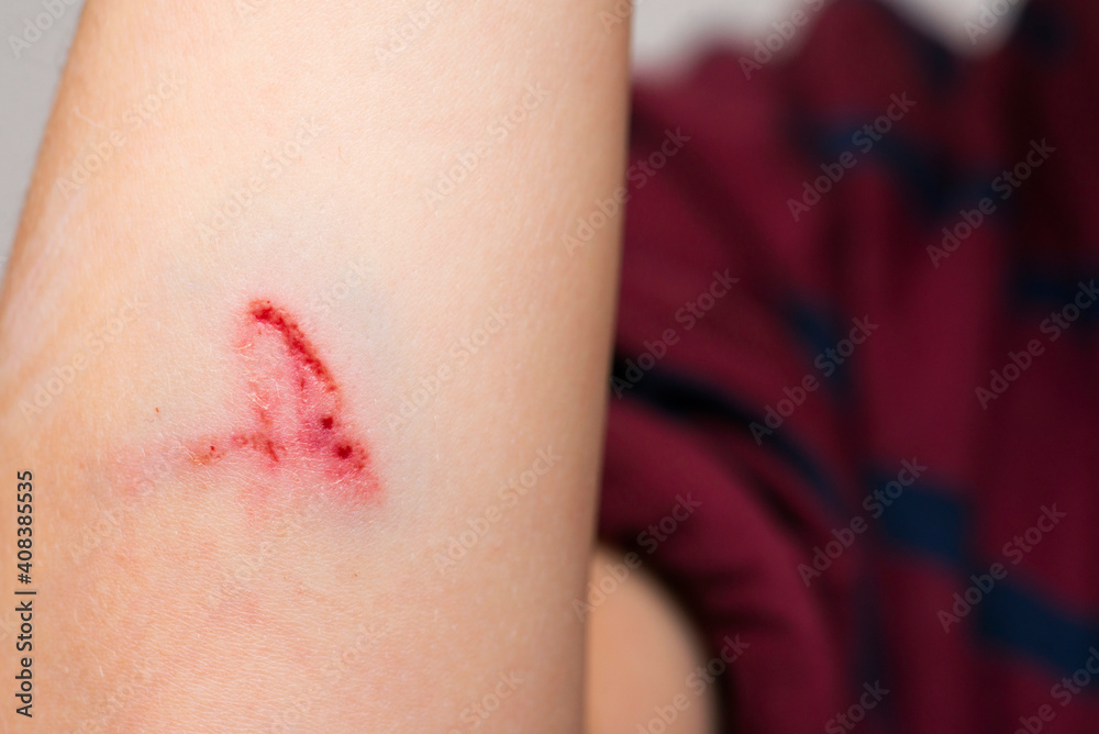 Deep scratches on the skin with bruises on the childs hand. Wounds ...