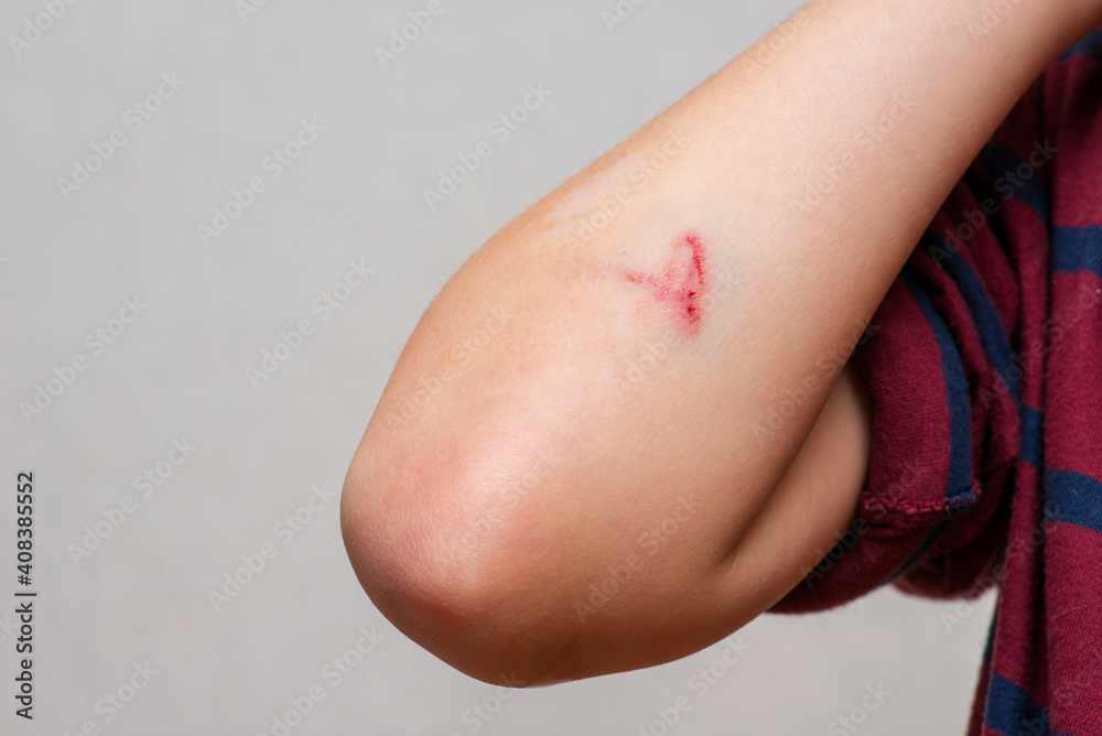 Deep scratches on the skin with bruises on the childs hand. Wounds ...