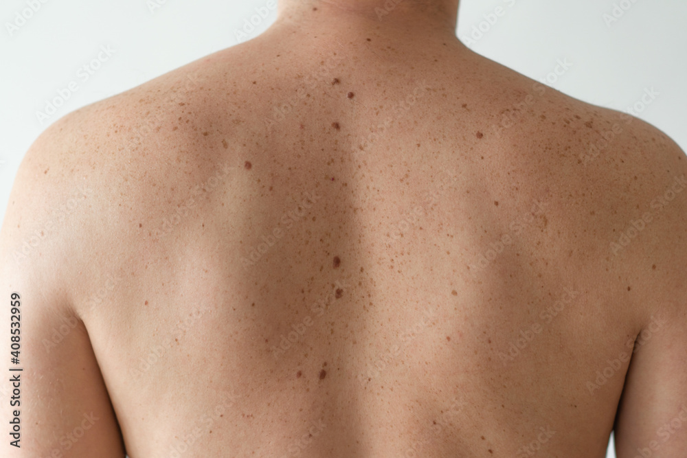 Checking benign moles. Close up detail of the bare skin on a man back ...