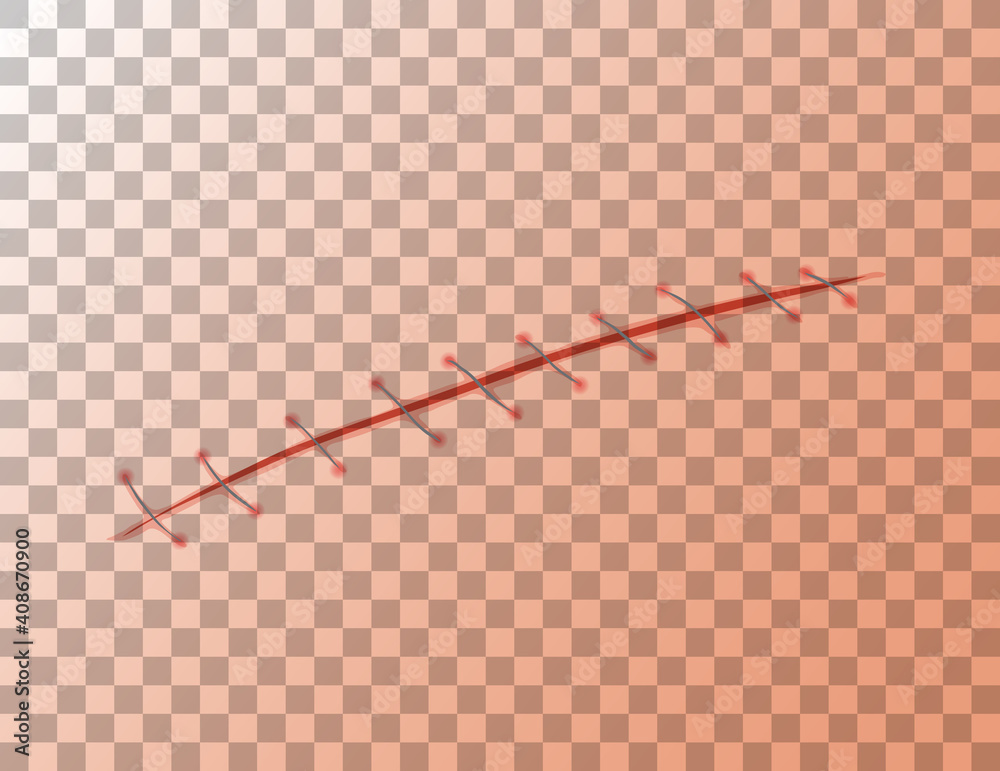 Wound suturing on transparent background Stock Vector | Adobe Stock