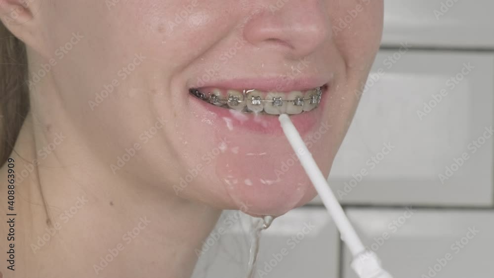 Close-up caucasian woman cleans braces using dental irrigator with ...