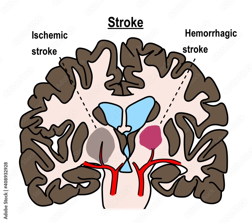 Stroke iis composed of ischemic and hemorrhagic stroke. Stock ...