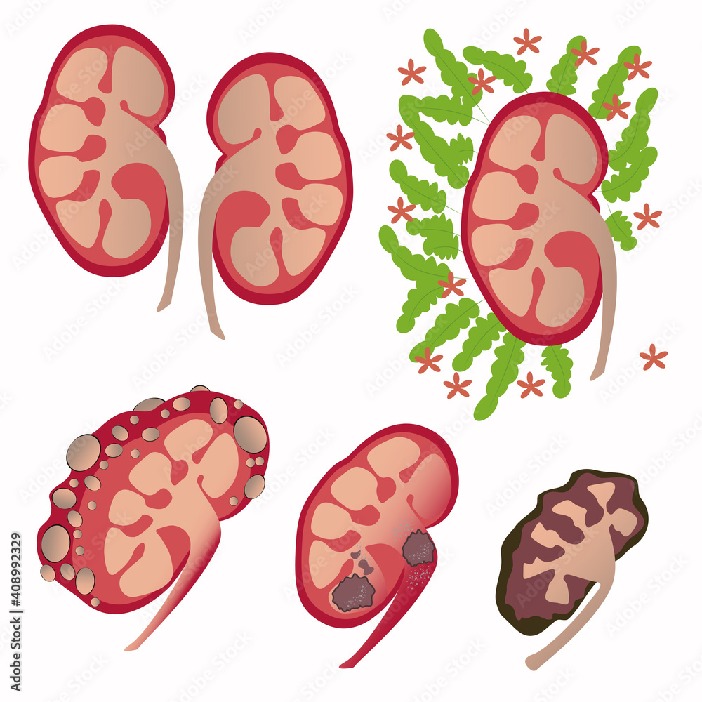 Different stages of kidney disease. Normal and polycystic kidneys ...
