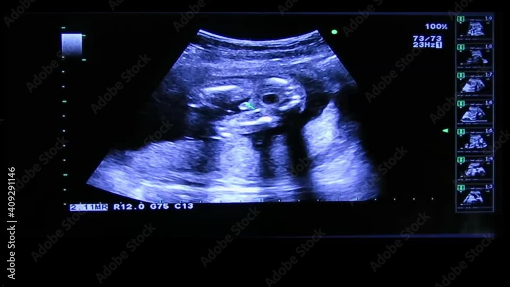Sex of human embryo on an ultrasound display, Monitor showing the male ...
