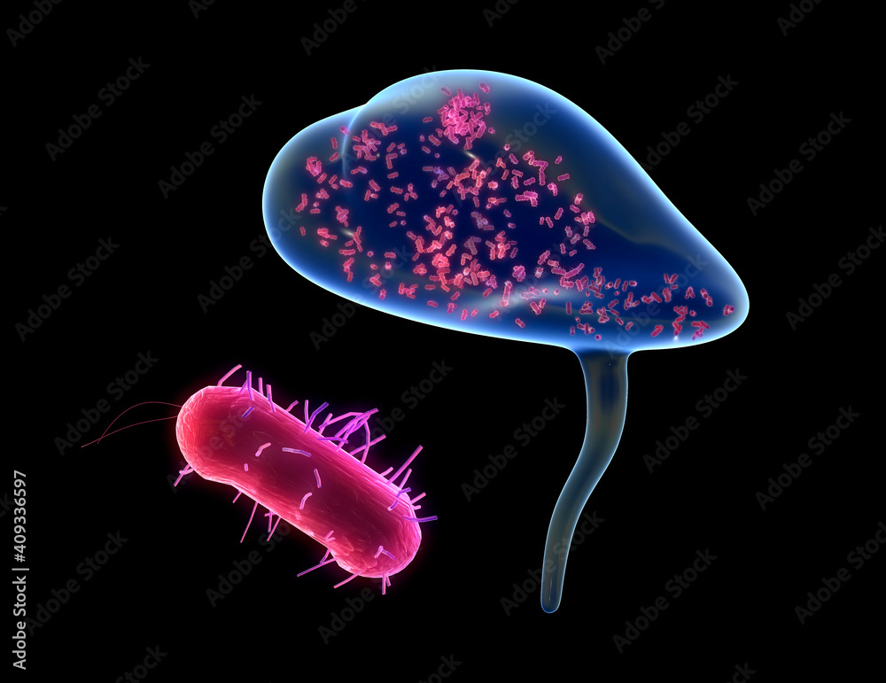 Inflammation of the bladder: Cystitis, urinary tract infection caused ...