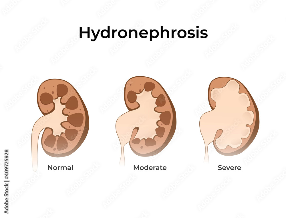 Normal kidney with hydronephrosis. Vector illustration of the of the ...