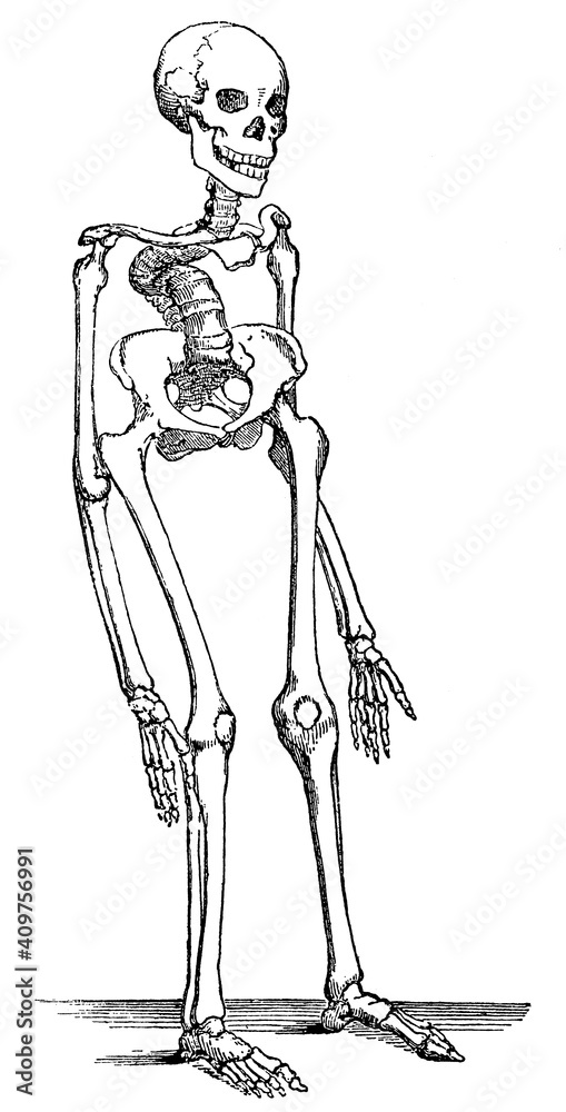 Human skeleton with rickets. Illustration of the 19th century. Germany ...