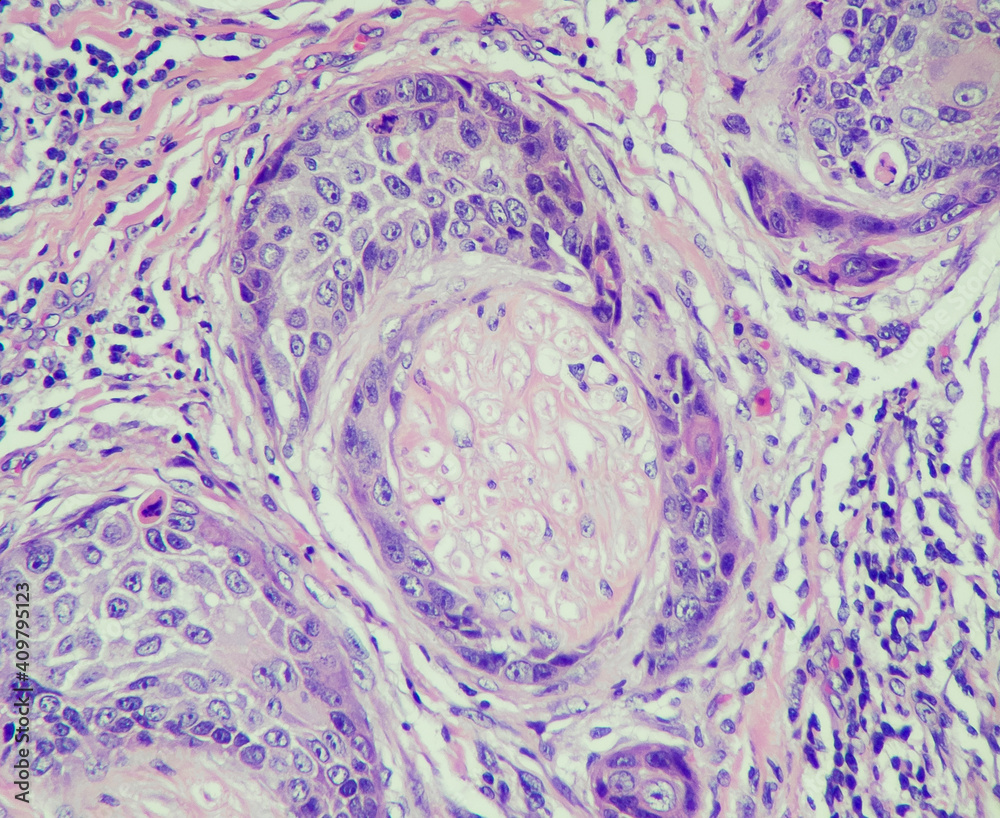 Photo of squamous cell carcinoma showing perineural invasion, magnification 400x, photo under ...