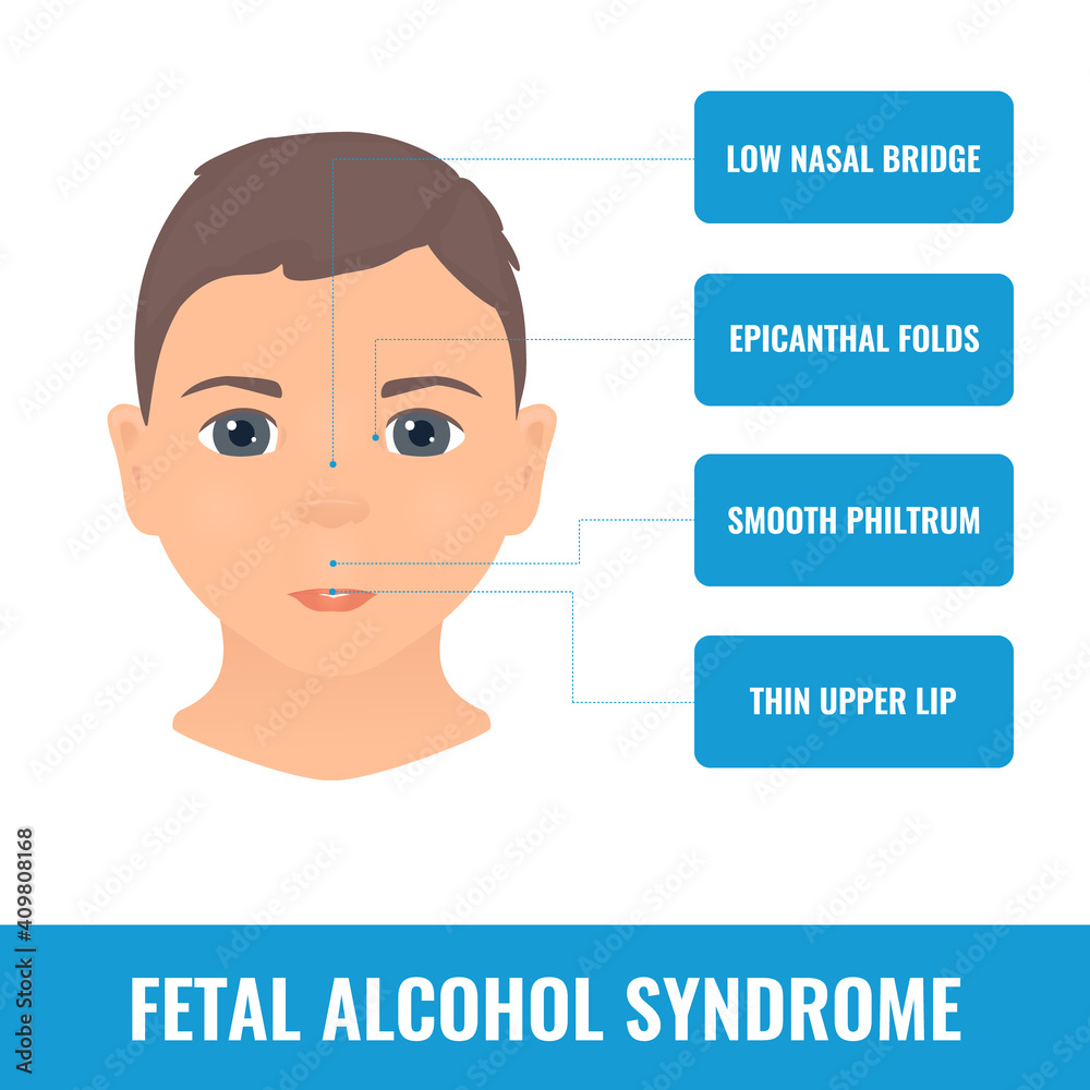Facial features in a child with fetal alcohol syndrome. Foetal alcohol ... Facial features in a child with fetal alcohol syndrome. Foetal alcohol ...