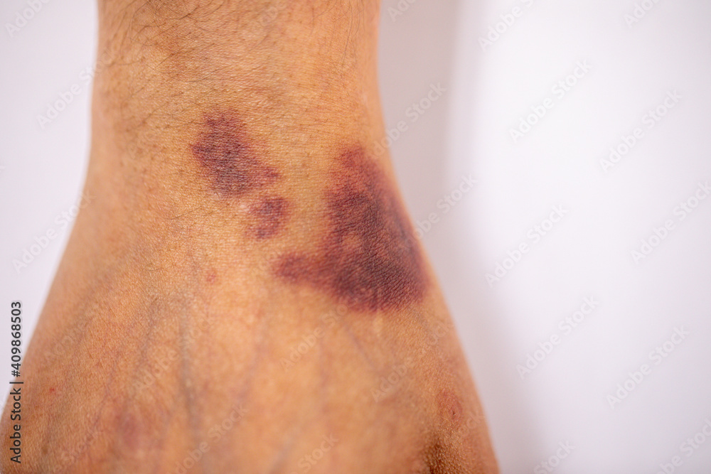 The physical appearance of the arm with the wound is caused by ...