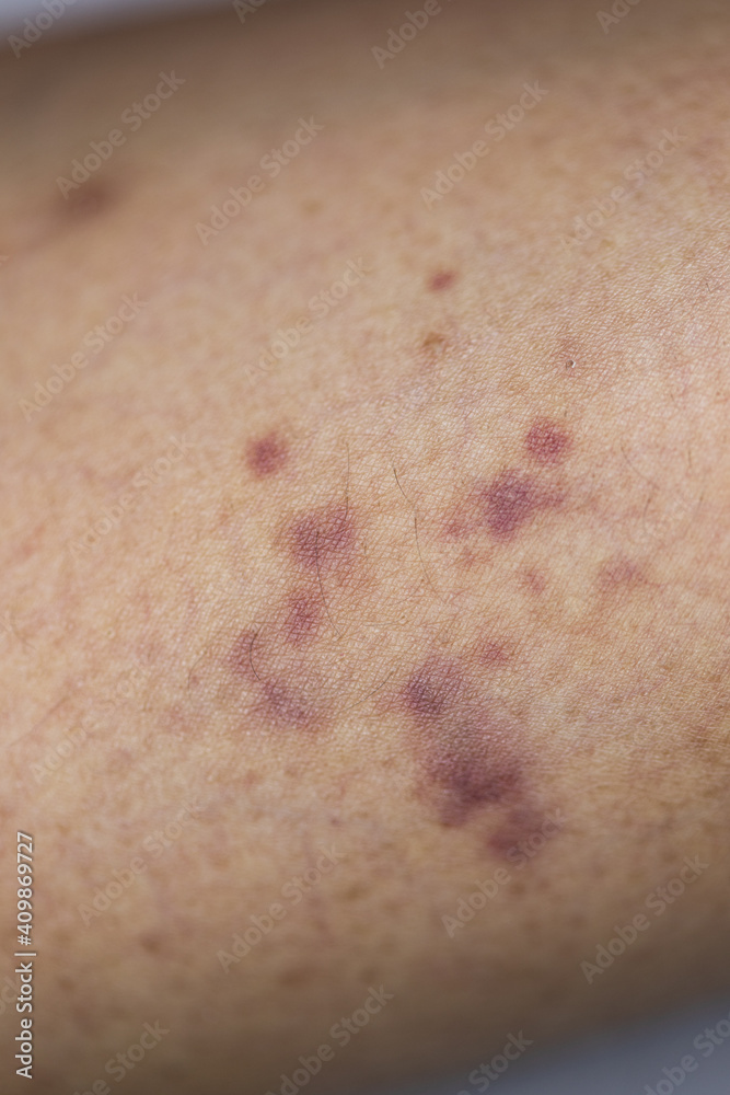 The physical appearance of the arm with the wound is caused by ...