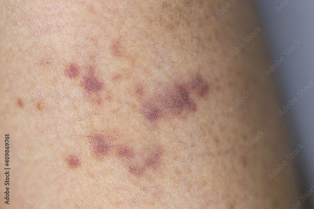 The physical appearance of the arm with the wound is caused by ...